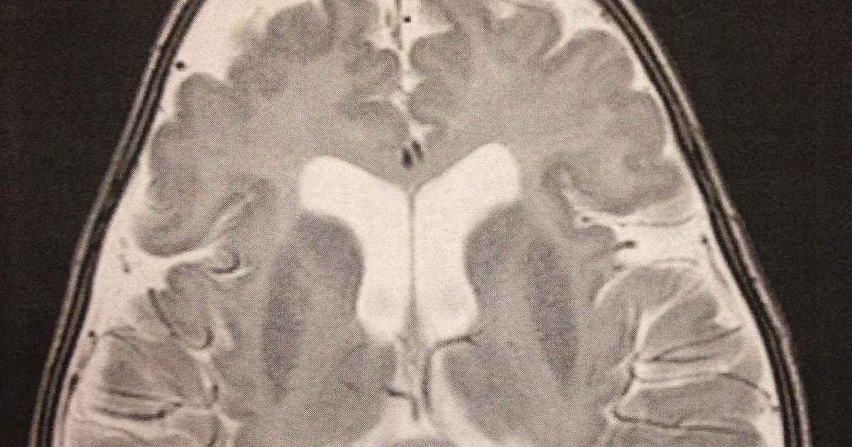 Cicily's Adventures: The incredible shrinking brain